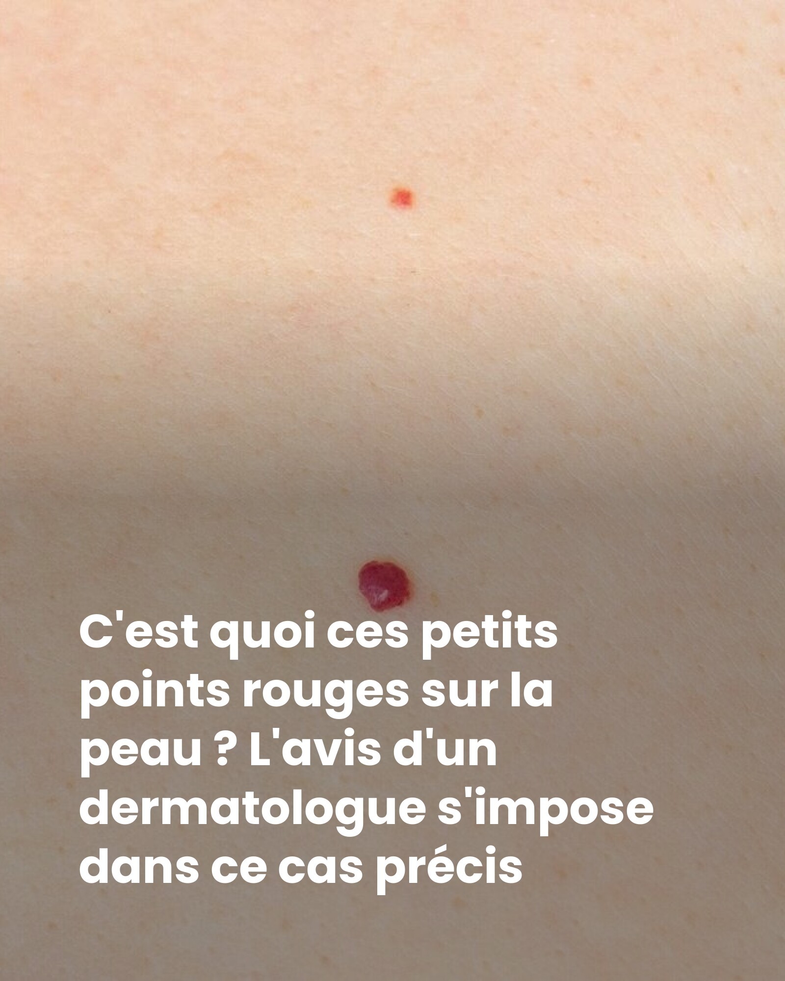 Des petits points rouges sur la peau ? Voici ce qu’il faut savoir ...